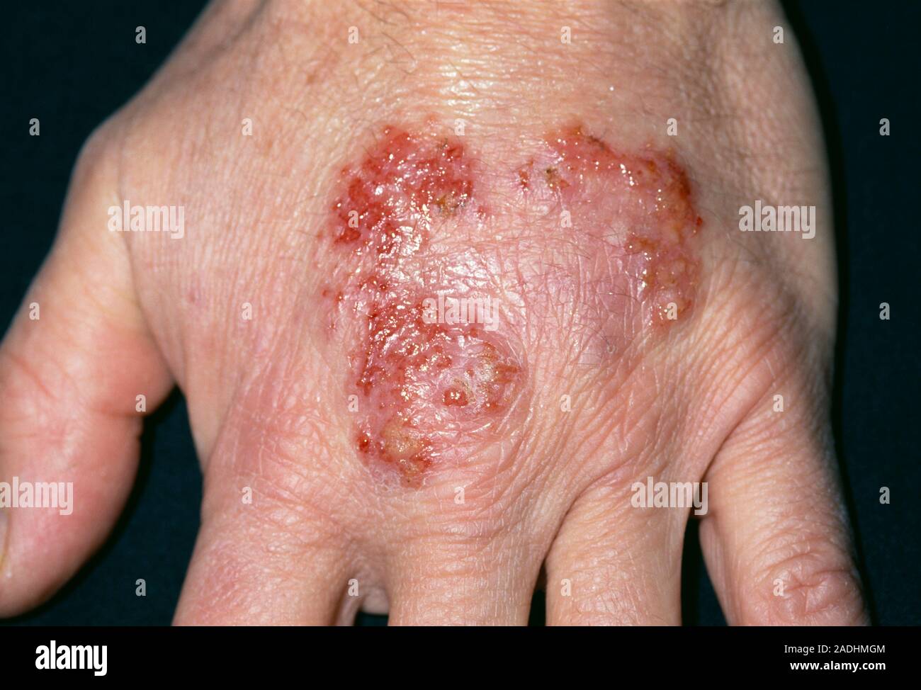 Psoriasis. Infected lesions on the back of a hand of a 50-year-old man ...