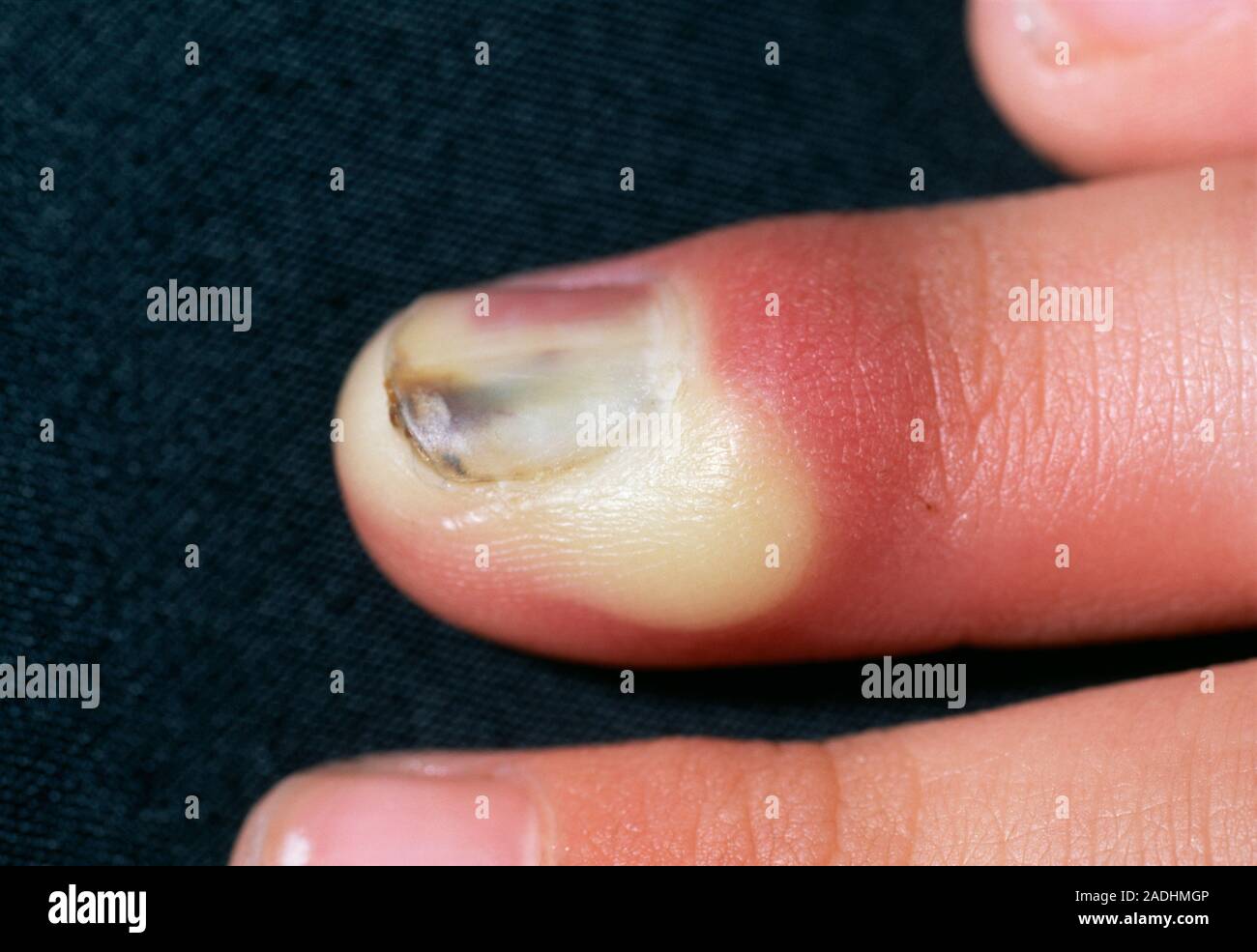 Acute paronychia. Close-up of a finger of a 5- year-old boy with ...