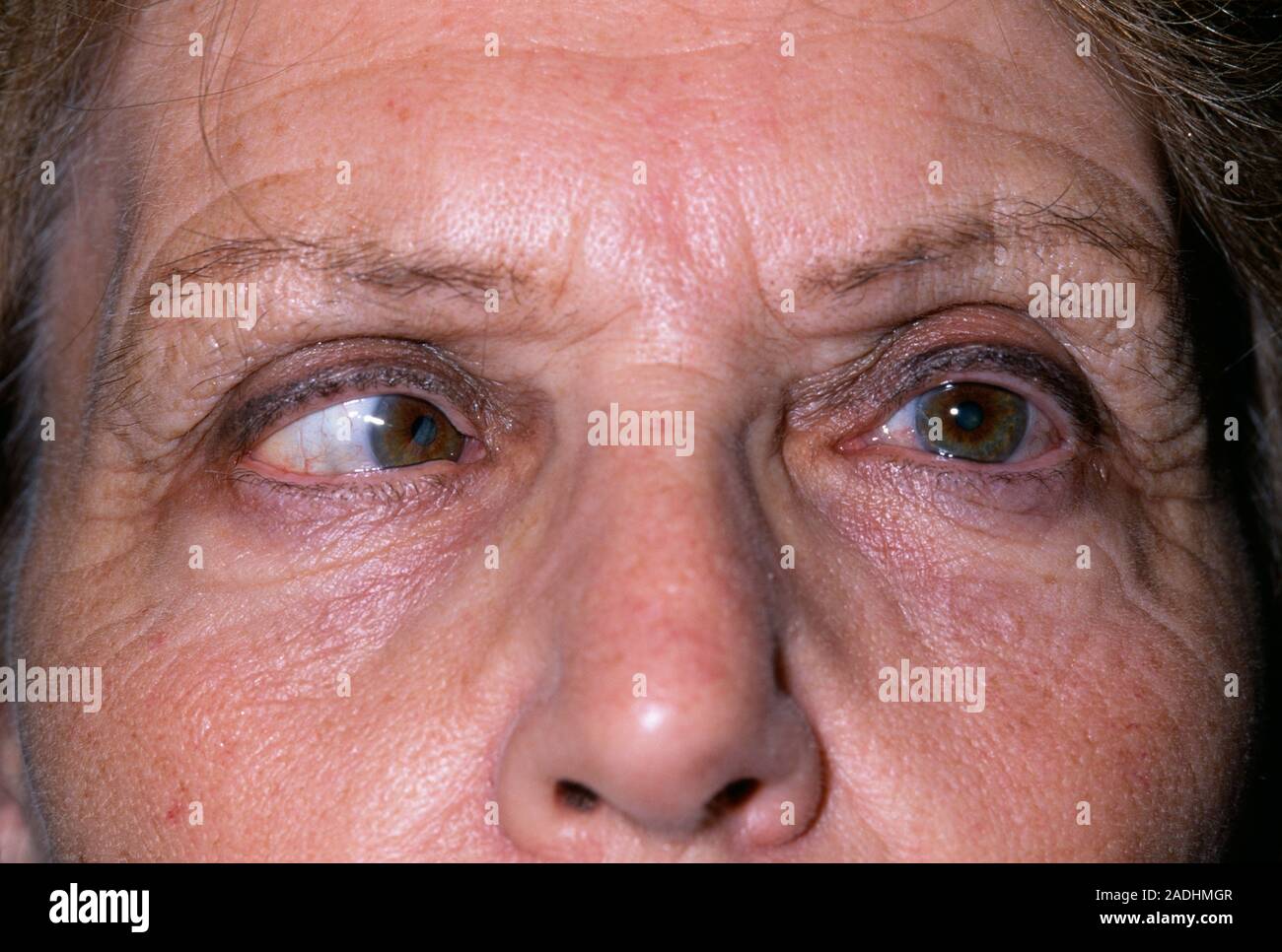 Facial palsy. Close-up of the eyes of a 73-year-old woman who has a ...
