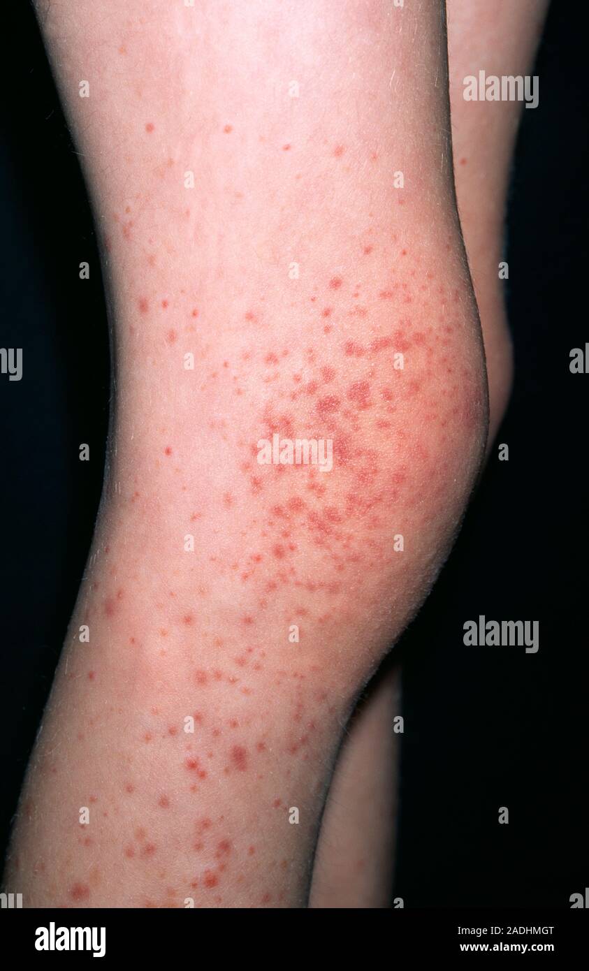 Henoch-Schonlein purpura. Purple rash on the leg of a 7-year-old boy ...
