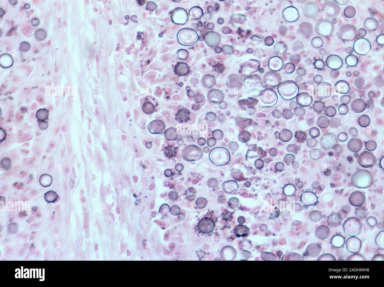 Paracoccidioidomycosis