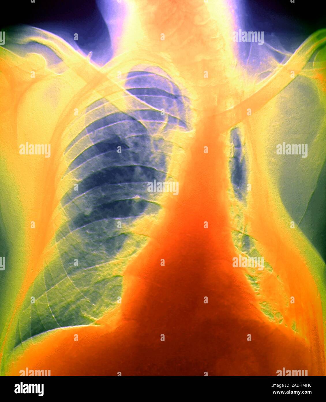 Pleurisy of the lungs. Coloured frontal X-ray of a patient's chest ...