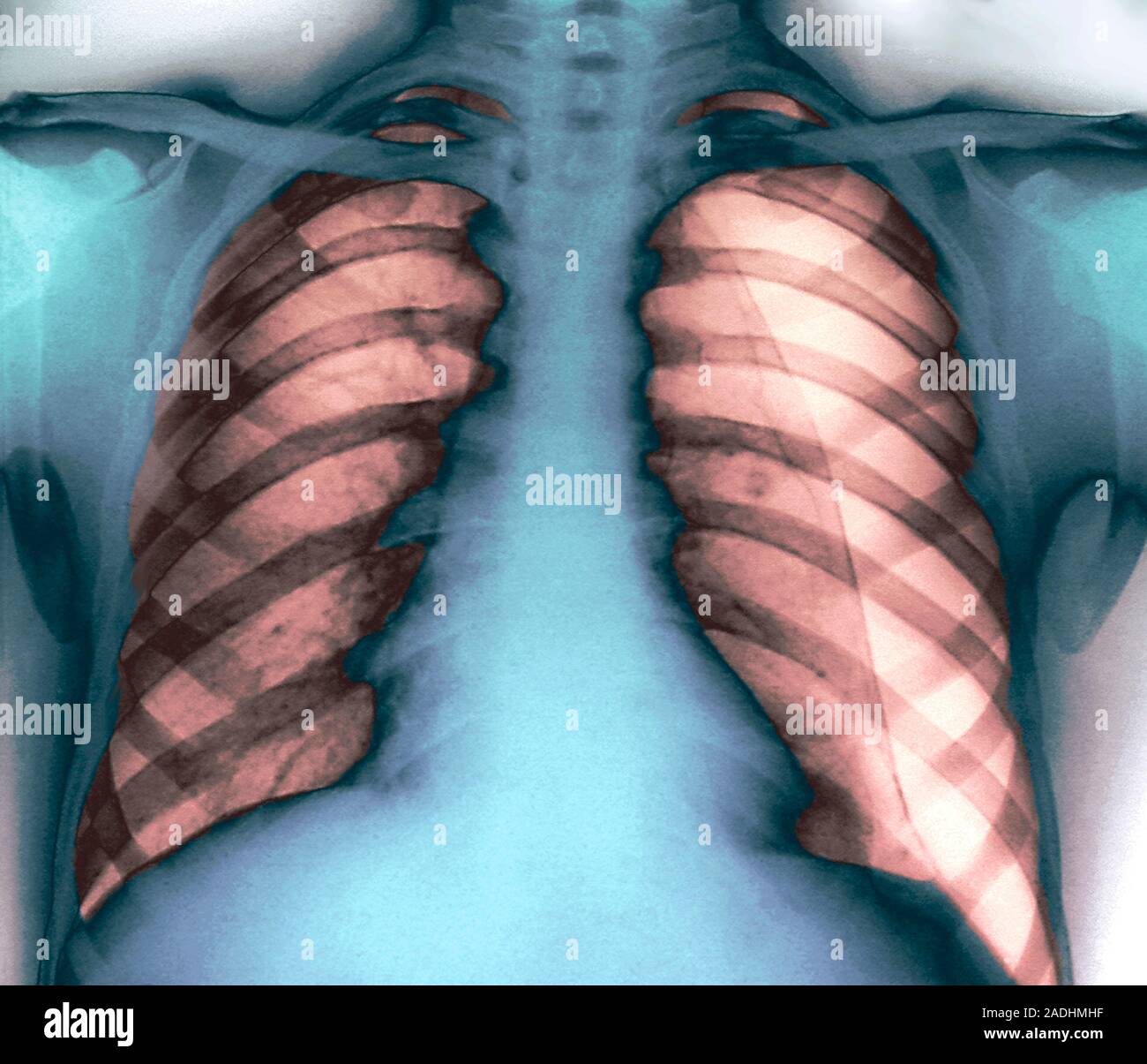 Pneumothorax. Coloured frontal chest X-ray of a patient with a ...