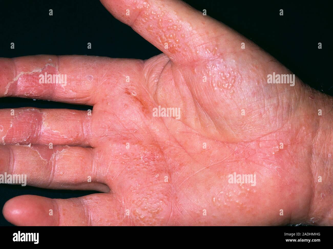 Skin rash. Pompholyx rash on the hand of a 56- year-old man. This is a ...