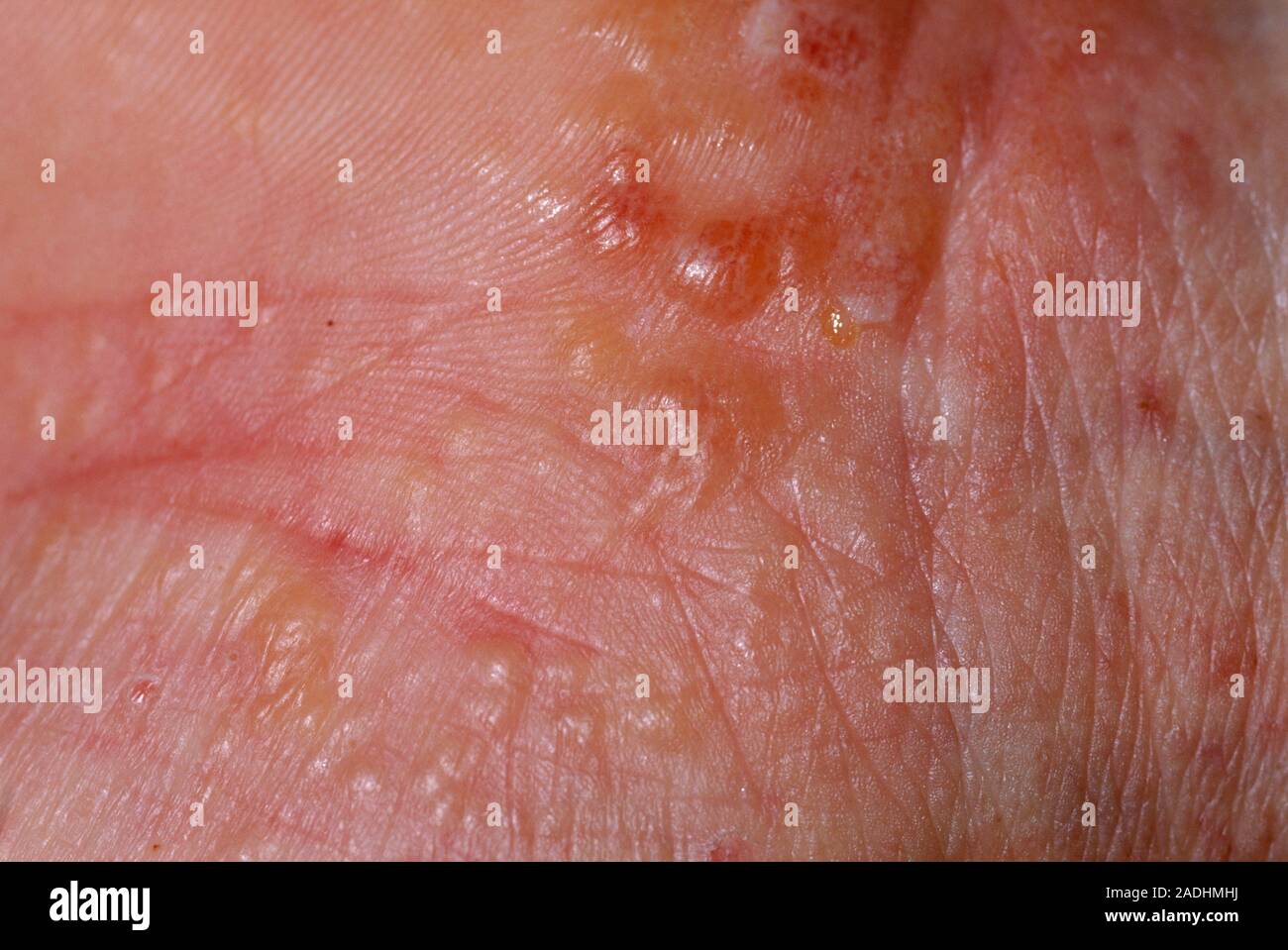 Skin rash. Pompholyx rash on the hand of a 56- year-old man. This is a ...