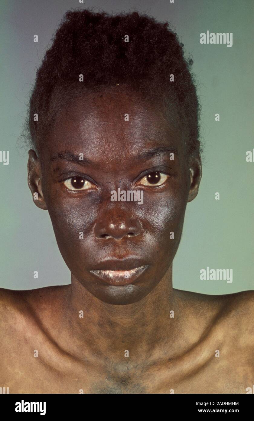 MODEL RELEASED. Porphyria on a patient's face. Porphyria is the term ...