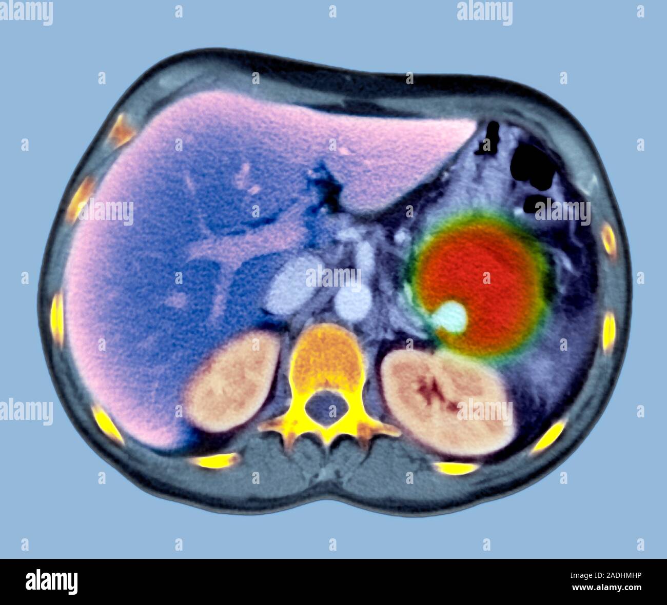 Pancreatitis. Coloured computed tomography (CT) scan of an axial section through a patient's ...