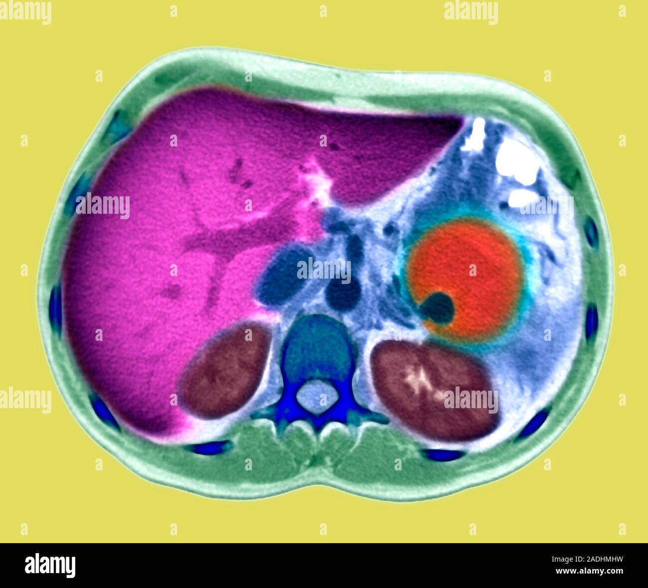 Pancreatitis Coloured Computed Tomography Ct Scan Of An Axial