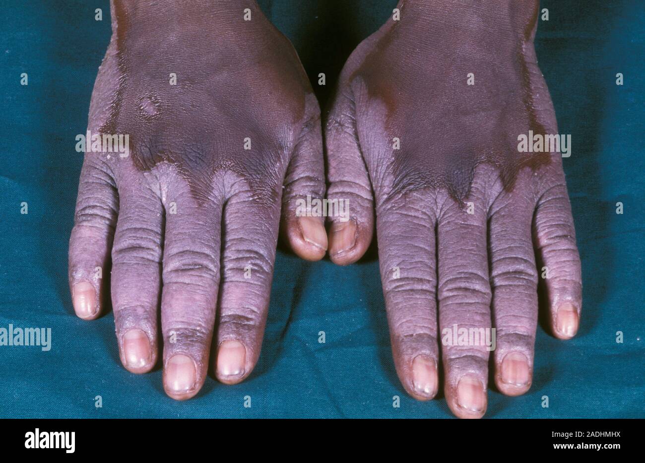 Psoriasis lesions (white) on a man's hands. This is a common skin ...