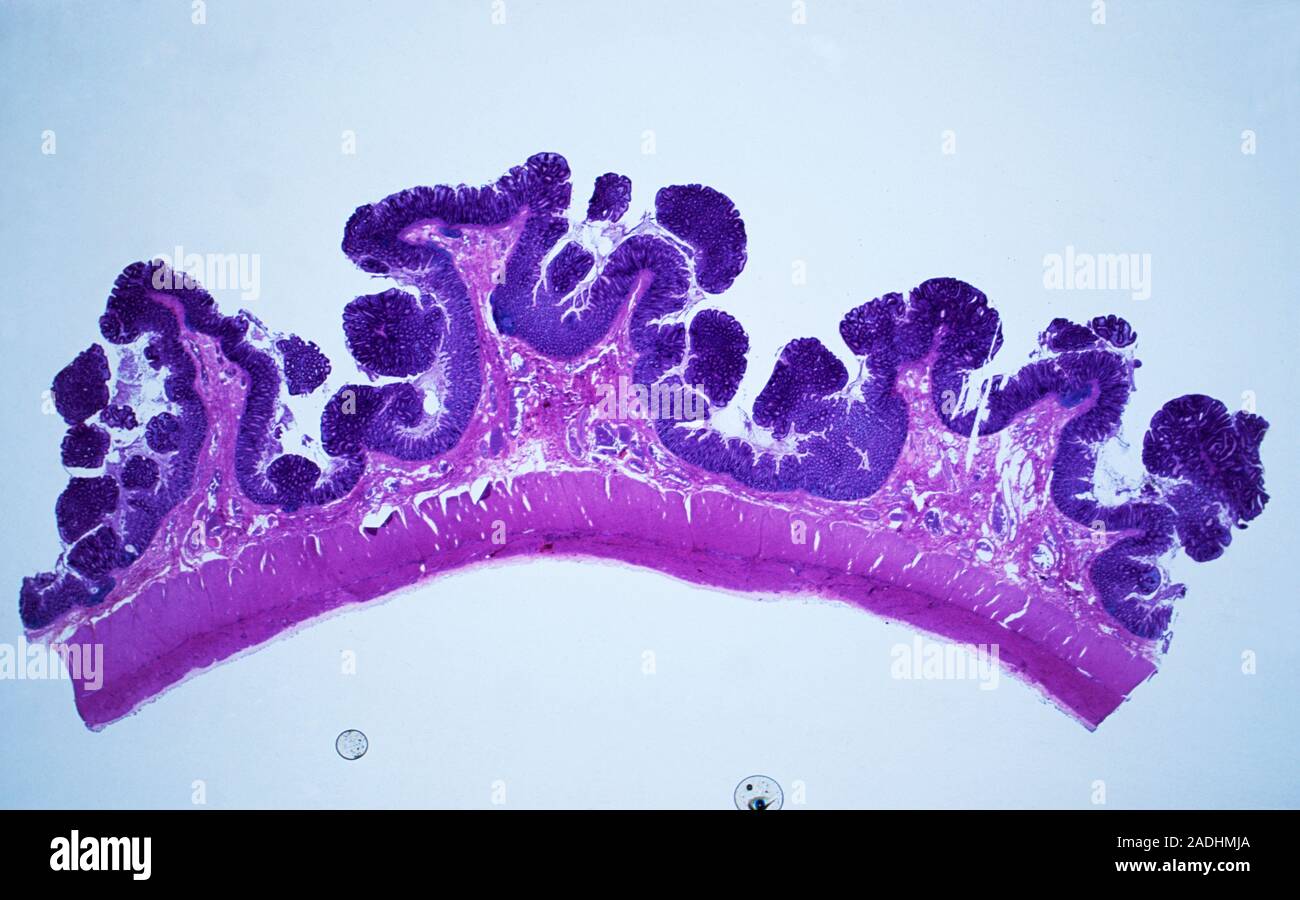 Colon polyps. Light micrograph of a section through the lining of the ...