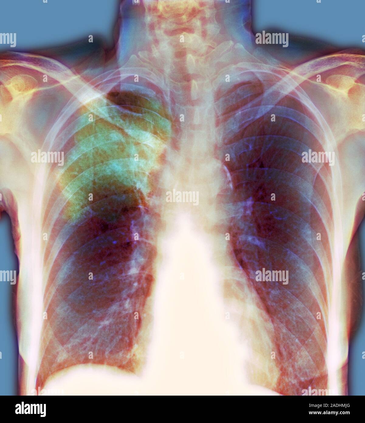 Pneumonia. Coloured frontal X-ray of a patient's chest showing ...