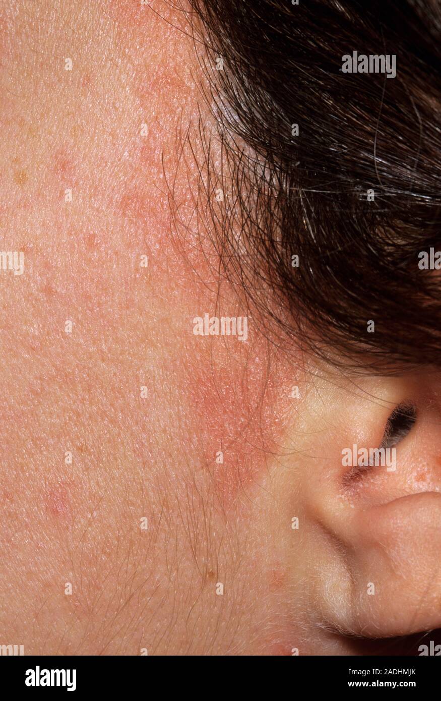 Psoriasis at the hairline on a 31 year old woman's face. Psoriasis is a ...