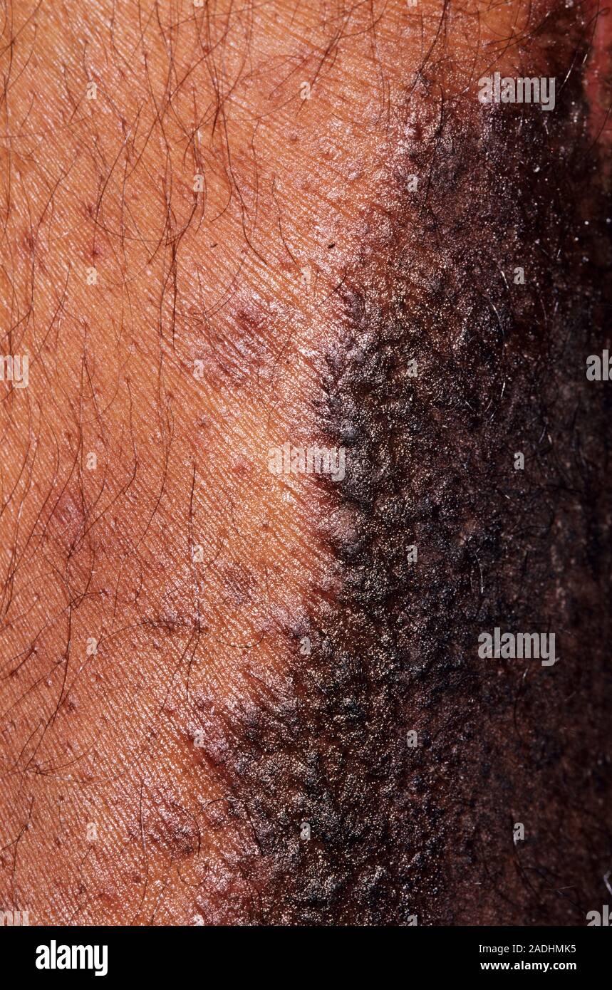 Psoriasis on the legs of a 38-year-old asian man's leg. Psoriasis is a ...