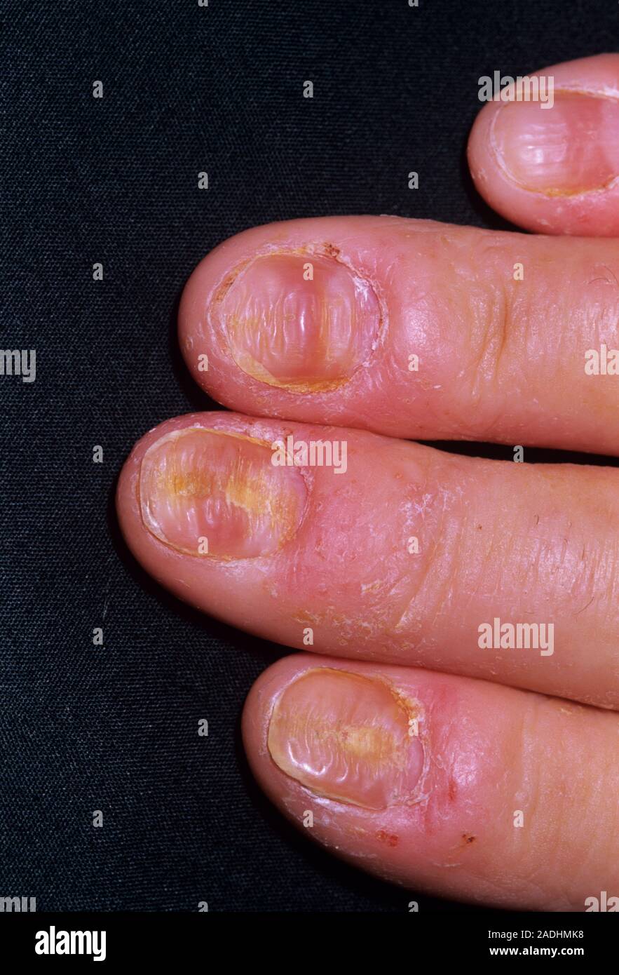 Psoriasis Affecting The Fingernails Of A 47 Year Old Man This Skin Condition Has Caused The