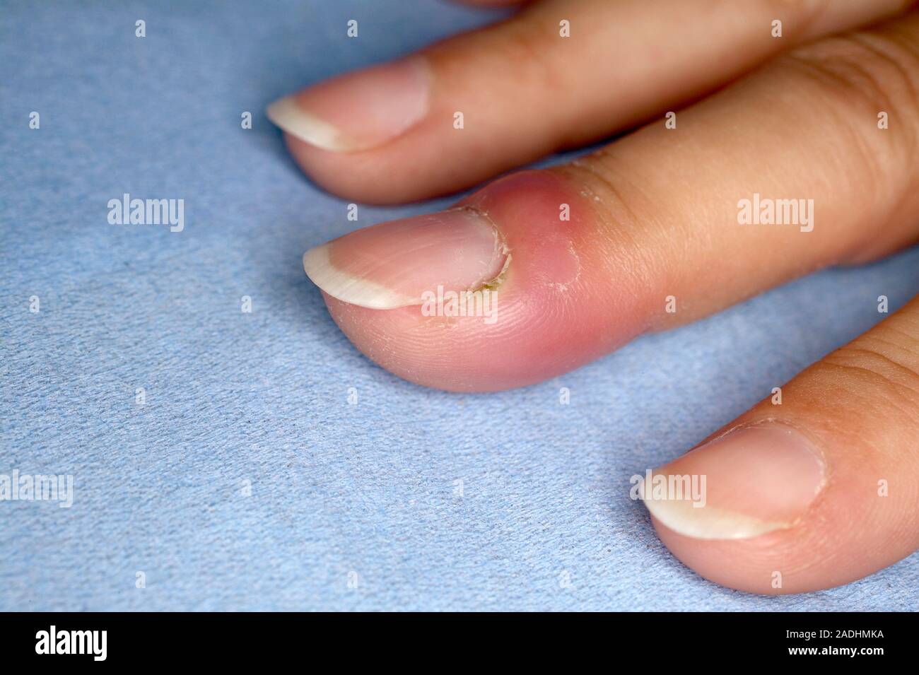 Paronychia infection. This is the red and swollen area at the base of ...