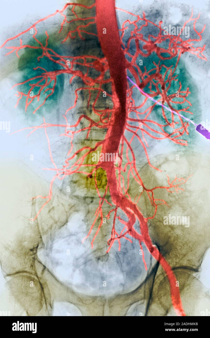 Phlebitis. Coloured angiogram of a patient with phlebitis of an iliac ...
