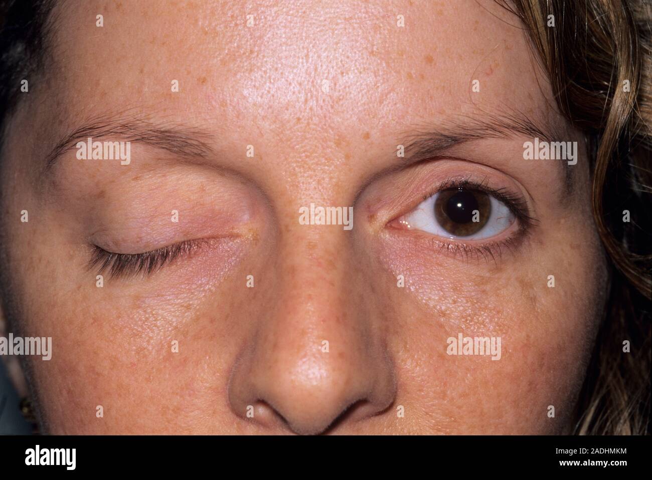 Oculomotor nerve palsy. Face of a 36-year-old woman with third (III ...