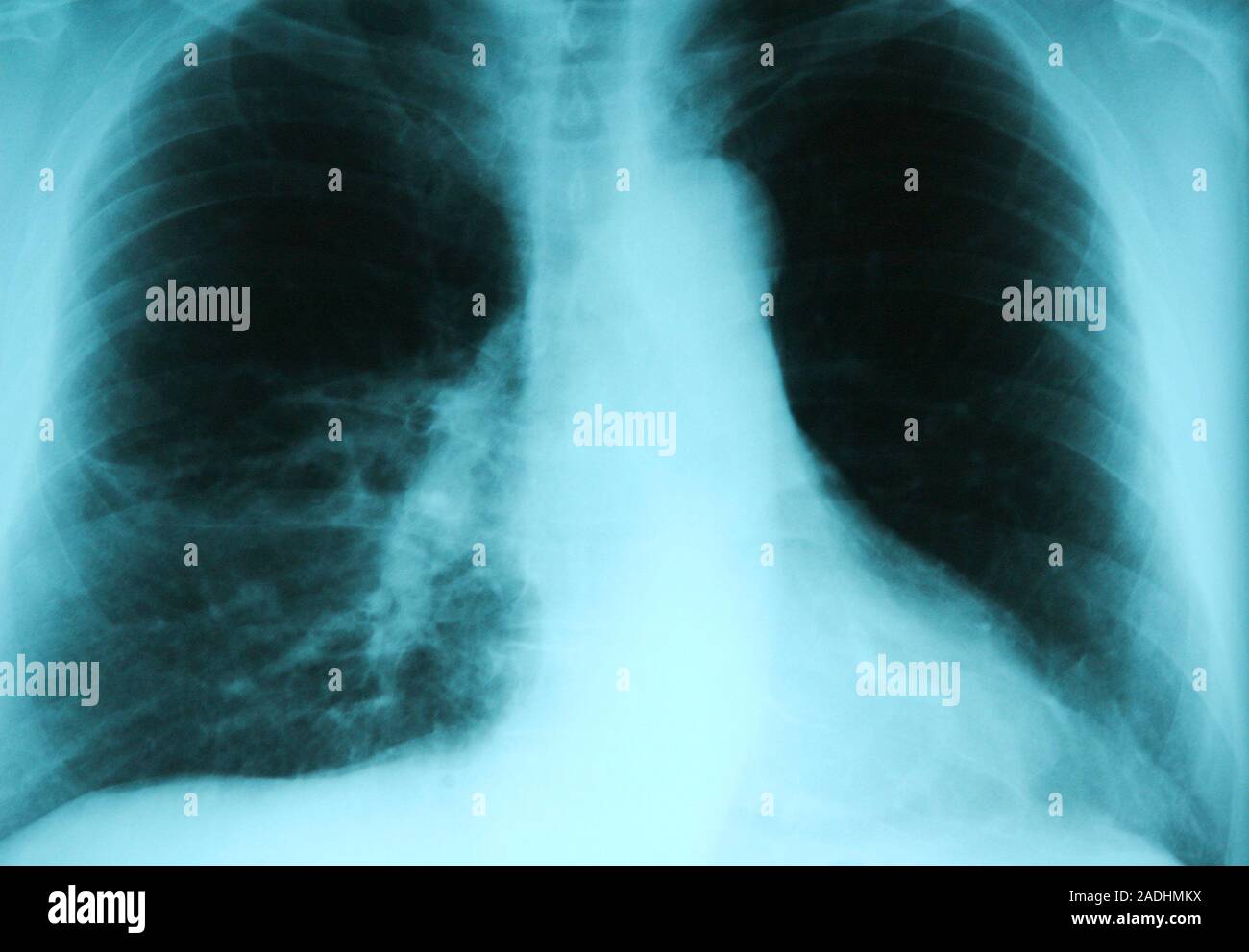 Pneumonia. Chest X-ray of a pneumonia infection (lower left) in the ...