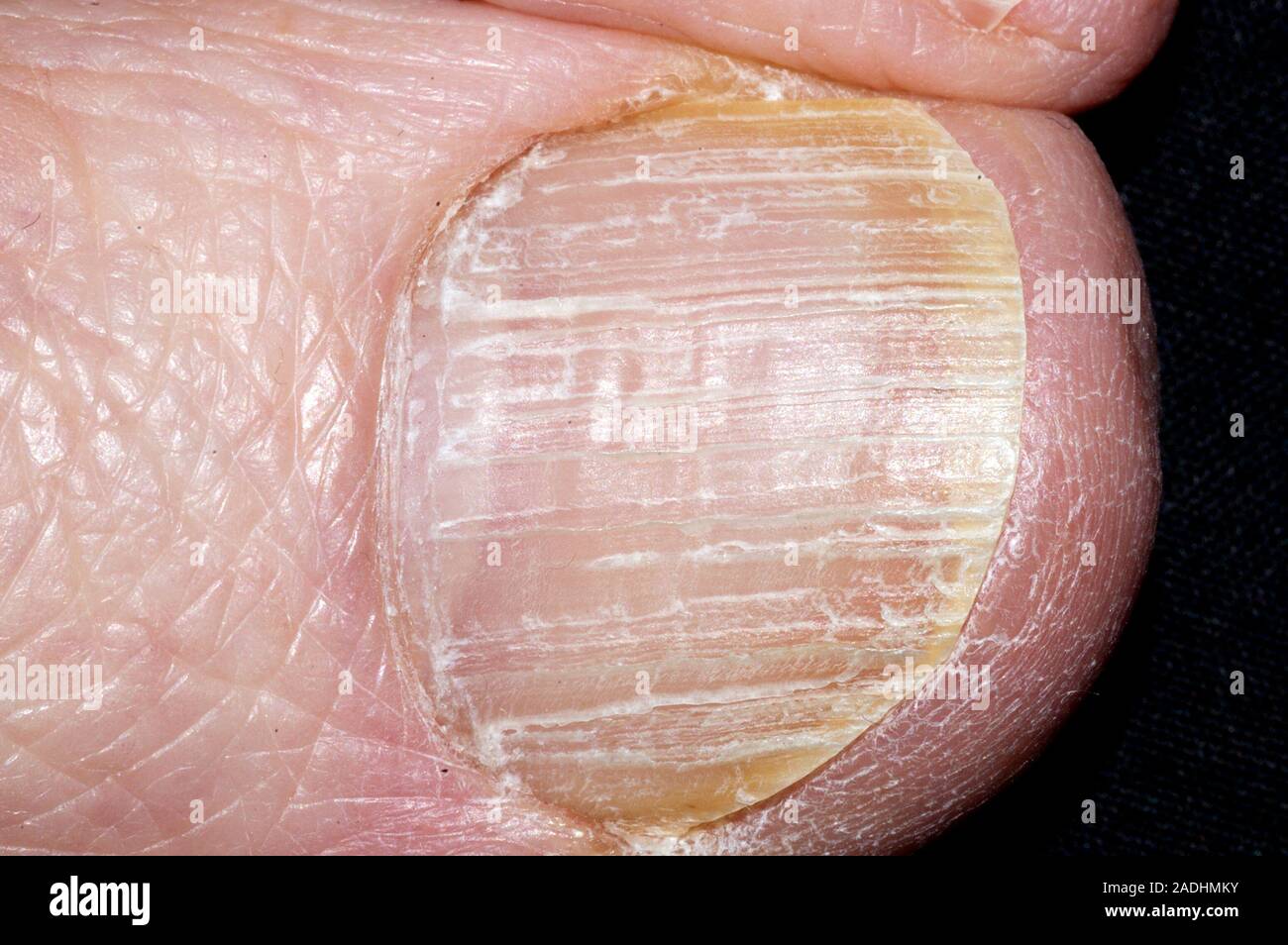 Psoriasis Affecting A Toe Nail Of A 54 Year Old Man This Skin Condition Has Caused The Nail To