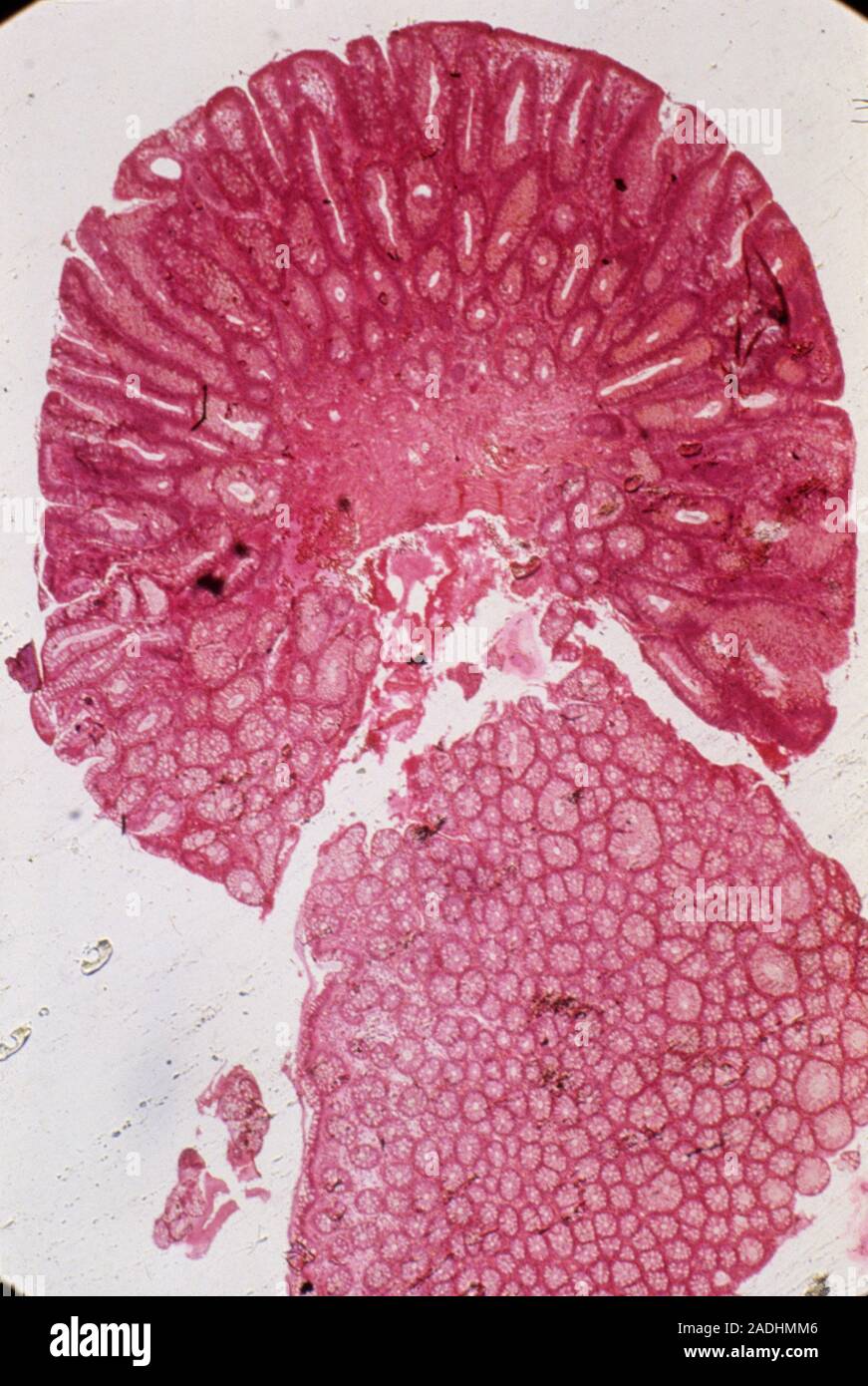 Rectal polyp. Light micrograph of a section through a rectal polyp. The ...