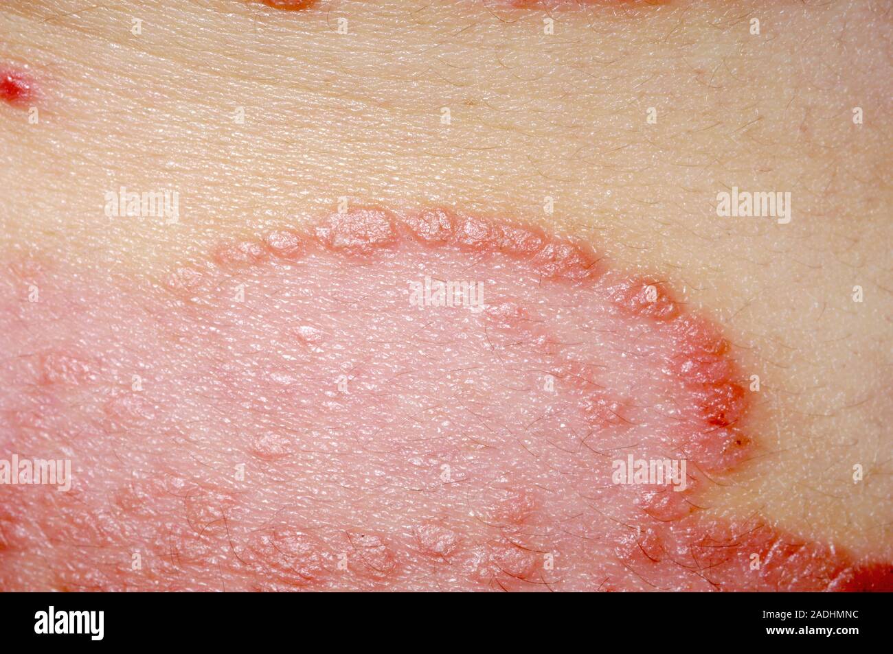 Psoriasis on the back of a 44 year old man after 2 weeks of treatment ...
