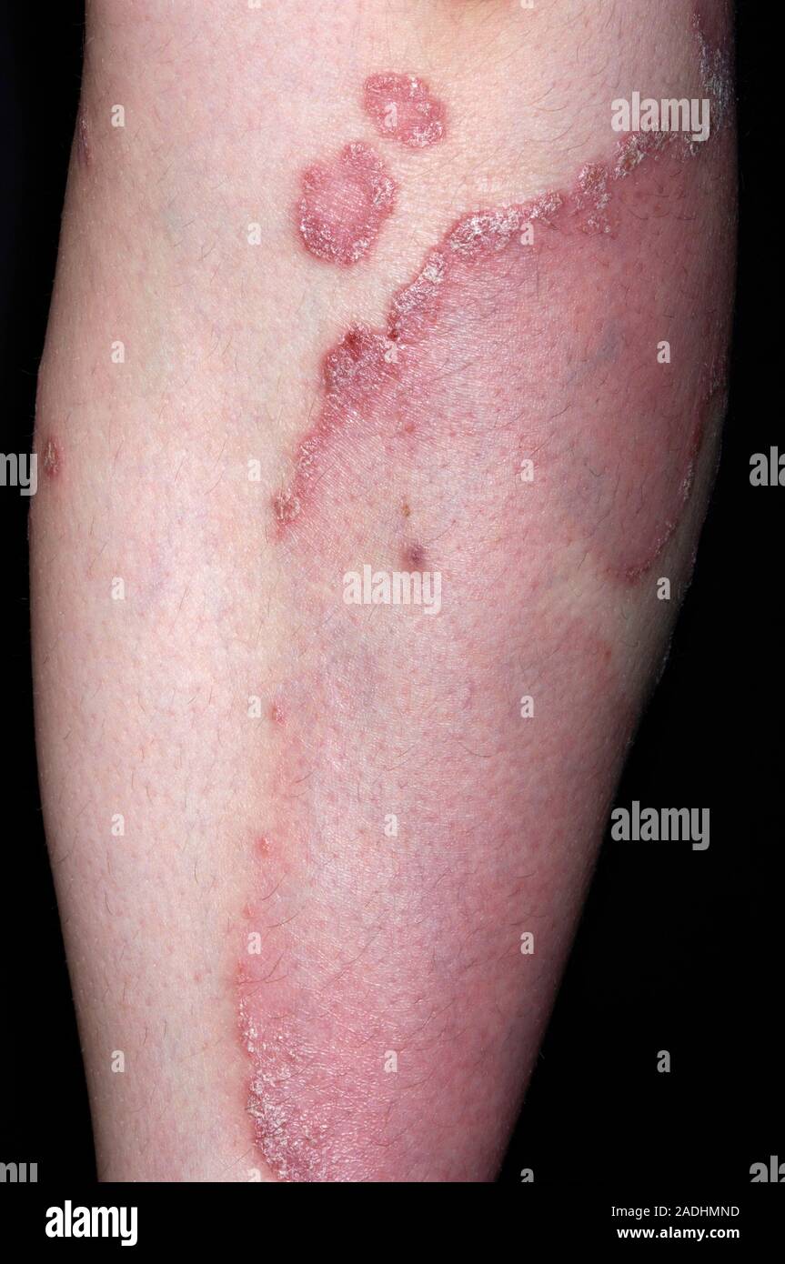 Psoriasis on the leg of a 27 year old woman after 8 weeks of treatment ...
