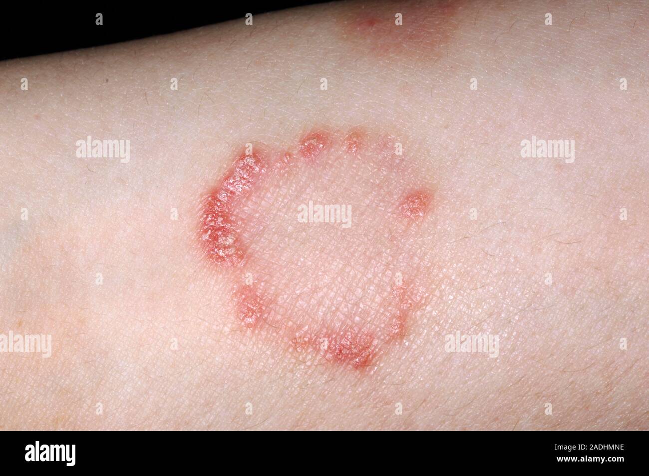 Psoriasis on the leg of a 27 year old woman after 8 weeks of treatment ...