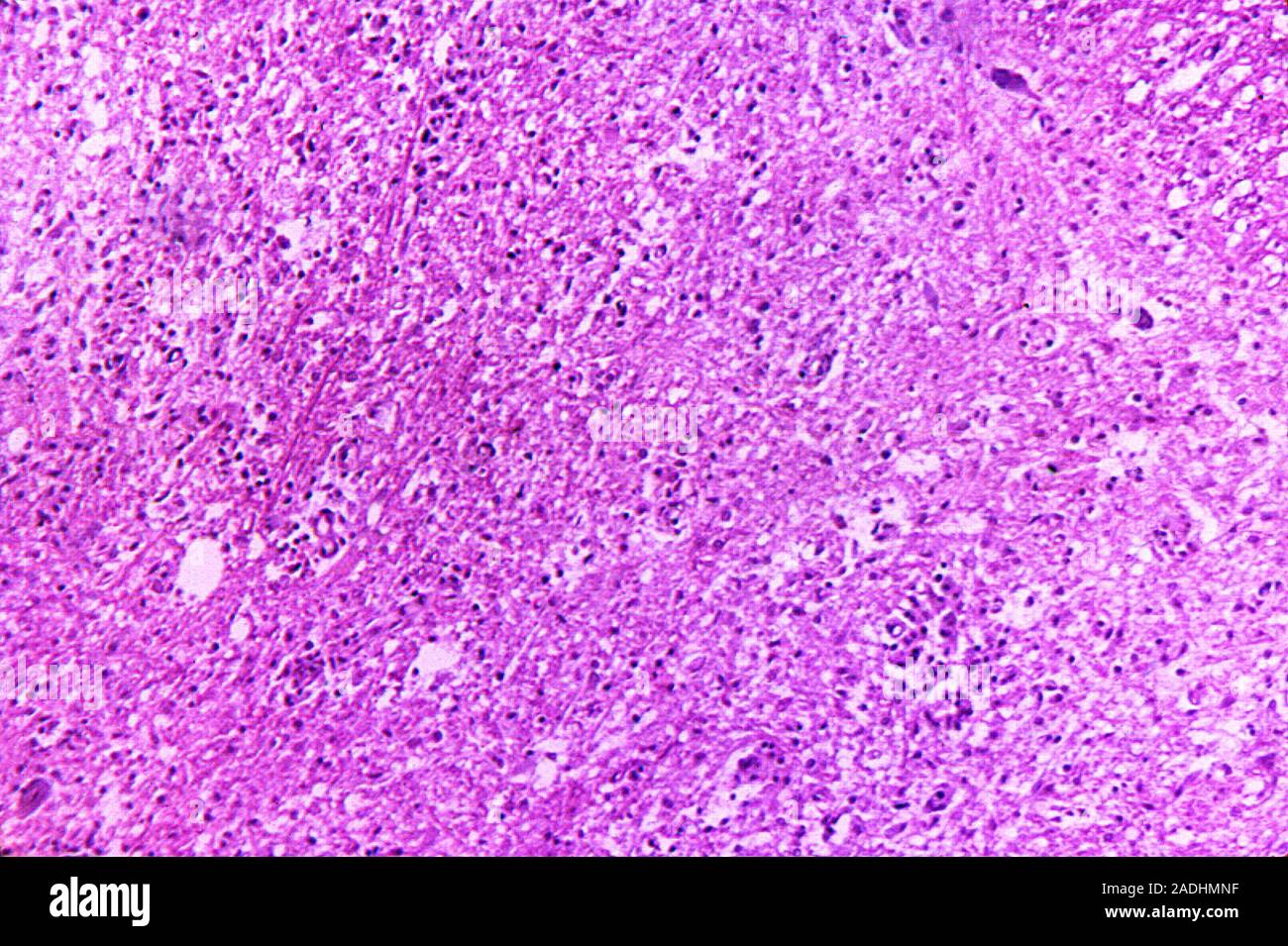 Polio affected spine. Light micrograph of a section through the ...