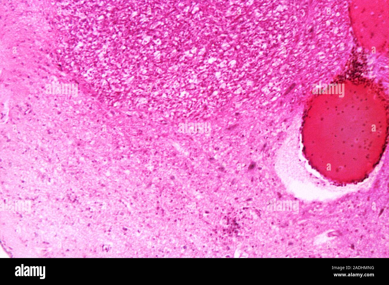 Polio affected brainstem. Light micrograph of a section through the ...