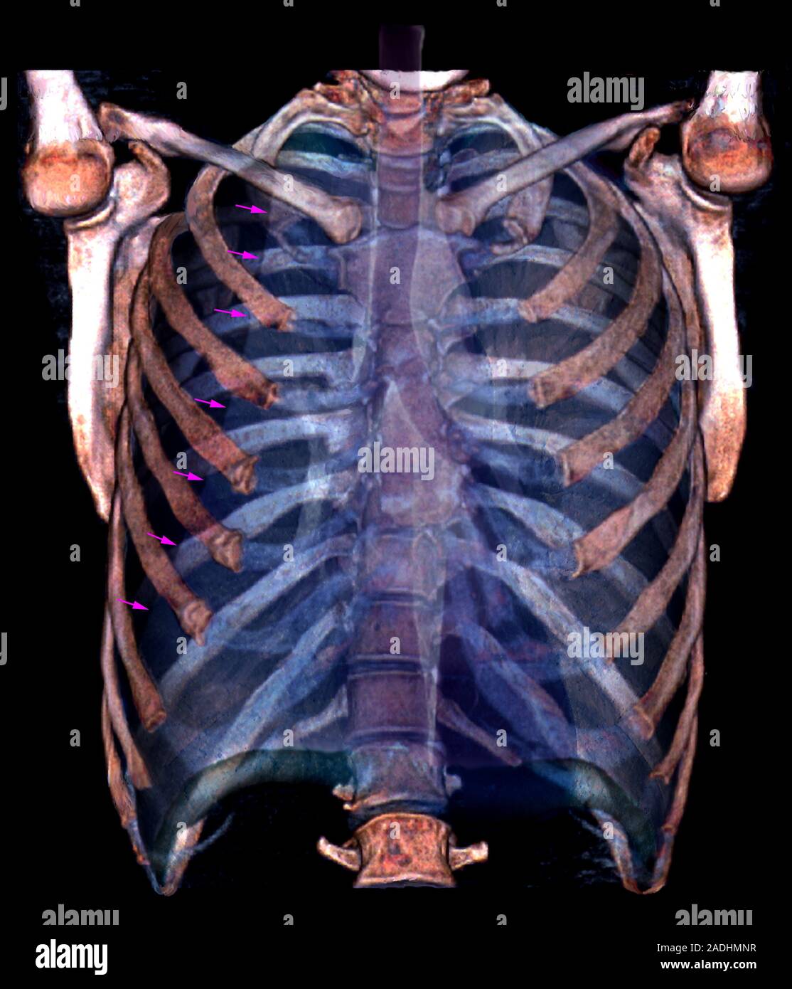 Pneumothorax. Coloured frontal 3D computed tomography (CT) scan of the ...