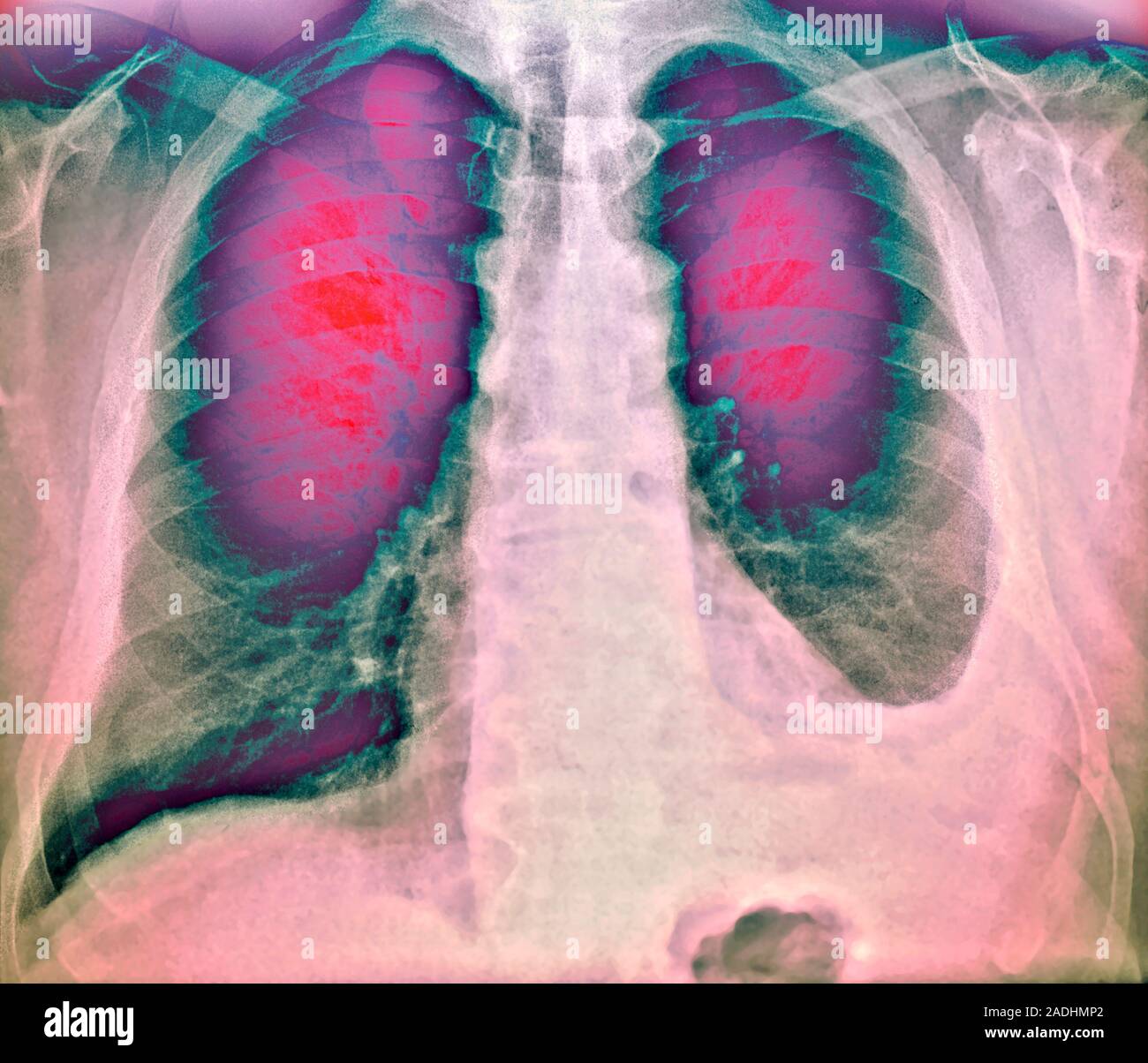 Pleural effusion. Coloured frontal X-ray of the lungs of a 60-year-old ...