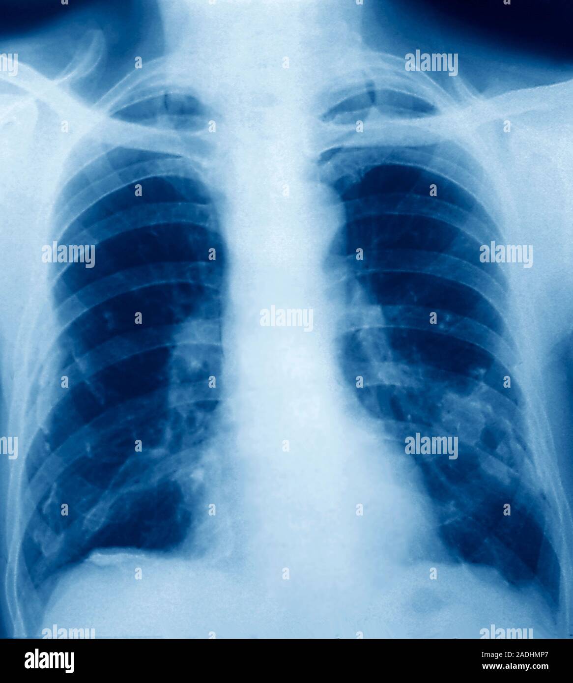 Pleural calcification. Coloured X-ray of the chest of a patient with ...