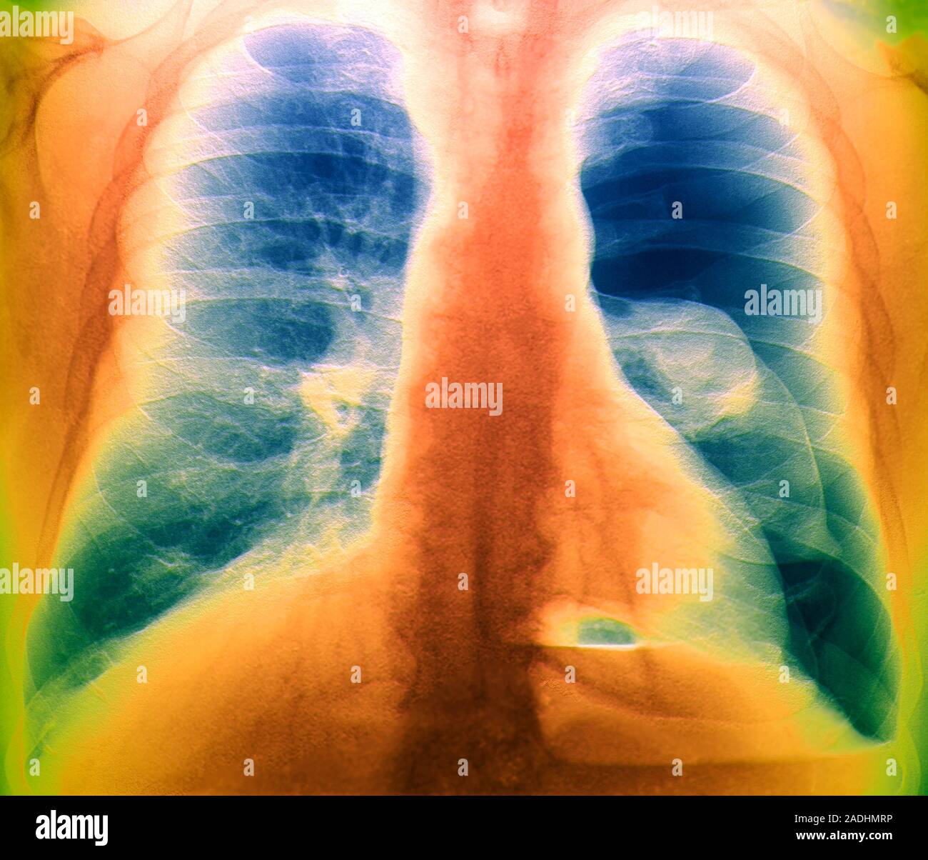 Pneumothorax. Coloured X-ray of the chest of a 76 year old with a ...