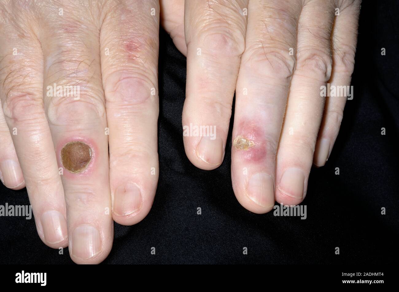 Pyoderma ulcers on the fingers of a 72 year old man following a kidney ...