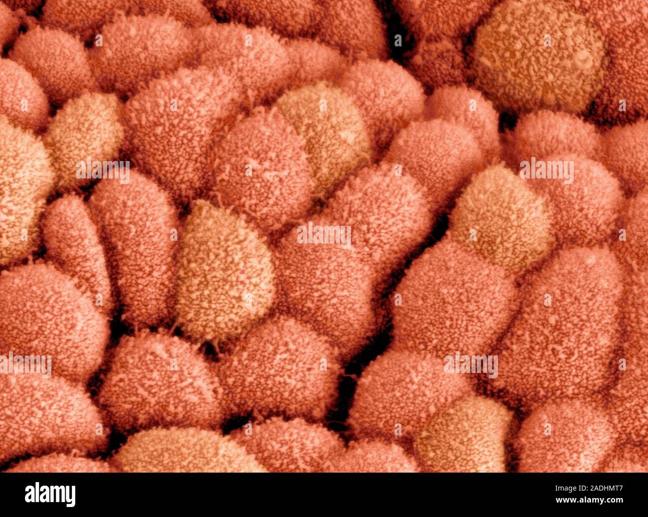 Rectal polyp. Coloured scanning electron micrograph (SEM) of the ...