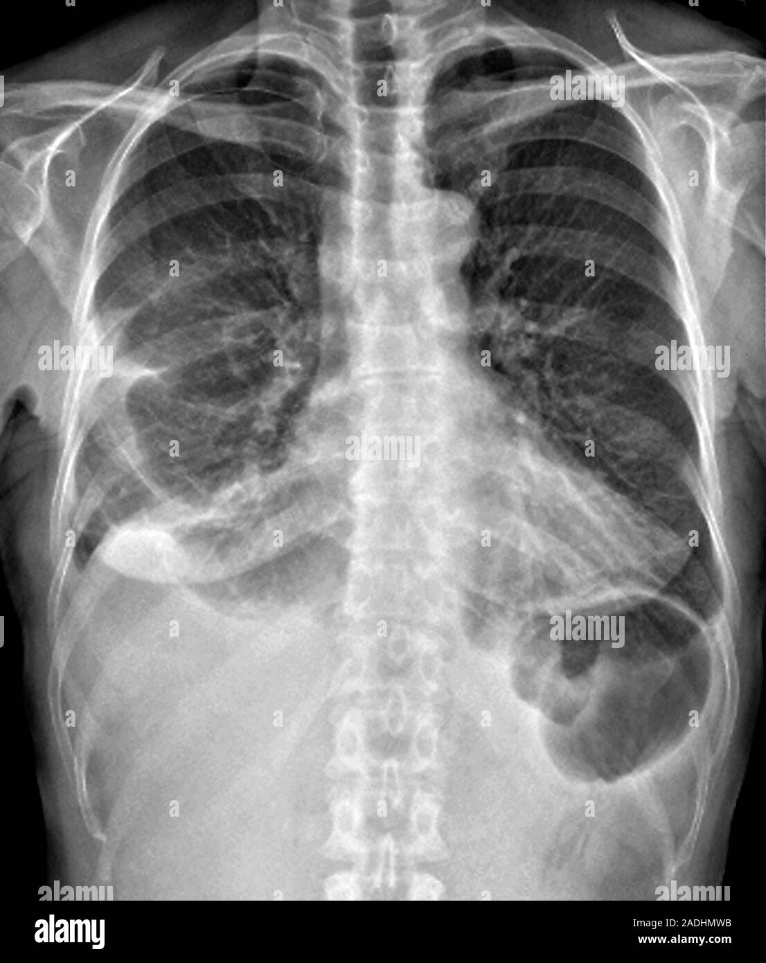 Pleurisy. X-ray of the lungs of a 65 year old patient with pleurisy, an ...