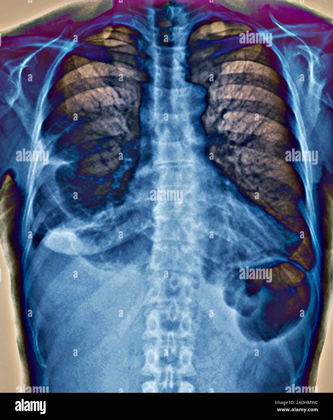 Pleurisy. Coloured X-ray of the lungs of a 65 year old patient with ...