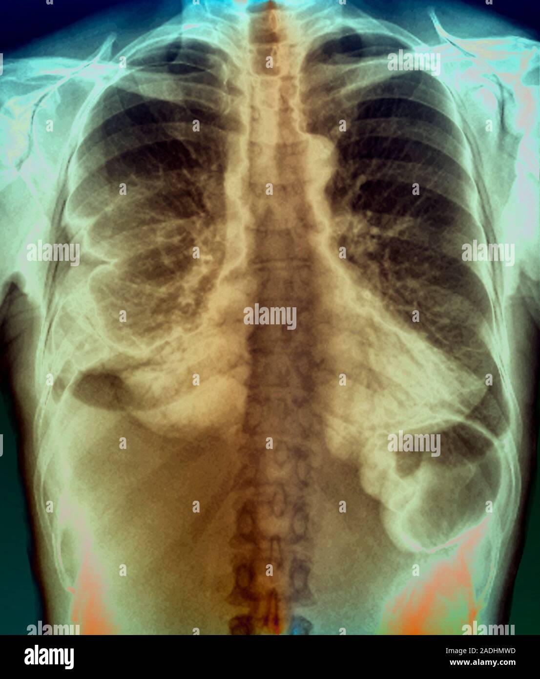 Pleurisy. Coloured X-ray of the lungs of a 65 year old patient with ...