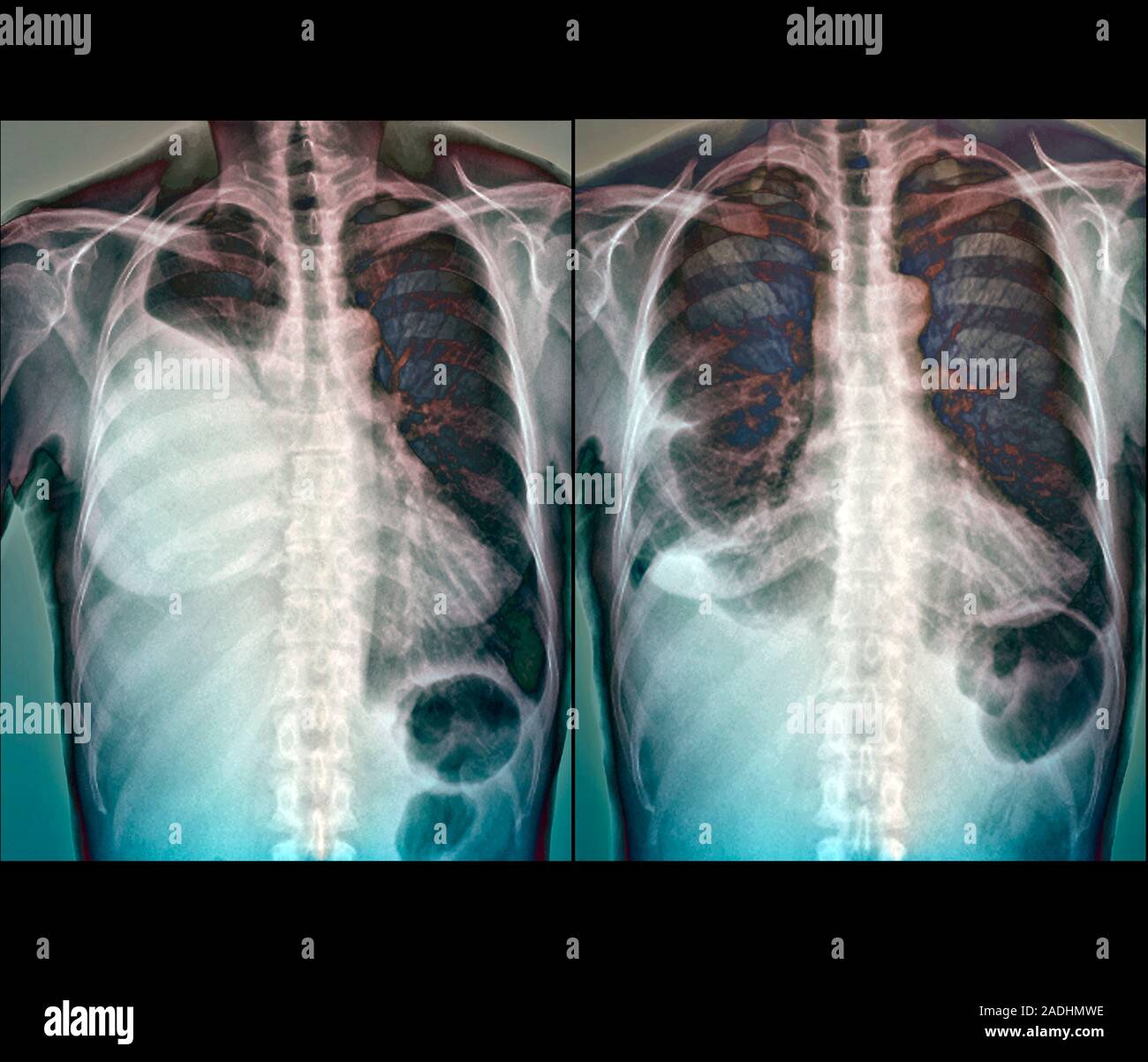 Pleurisy. Coloured X-rays of the lungs of a 65 year old patient with ...