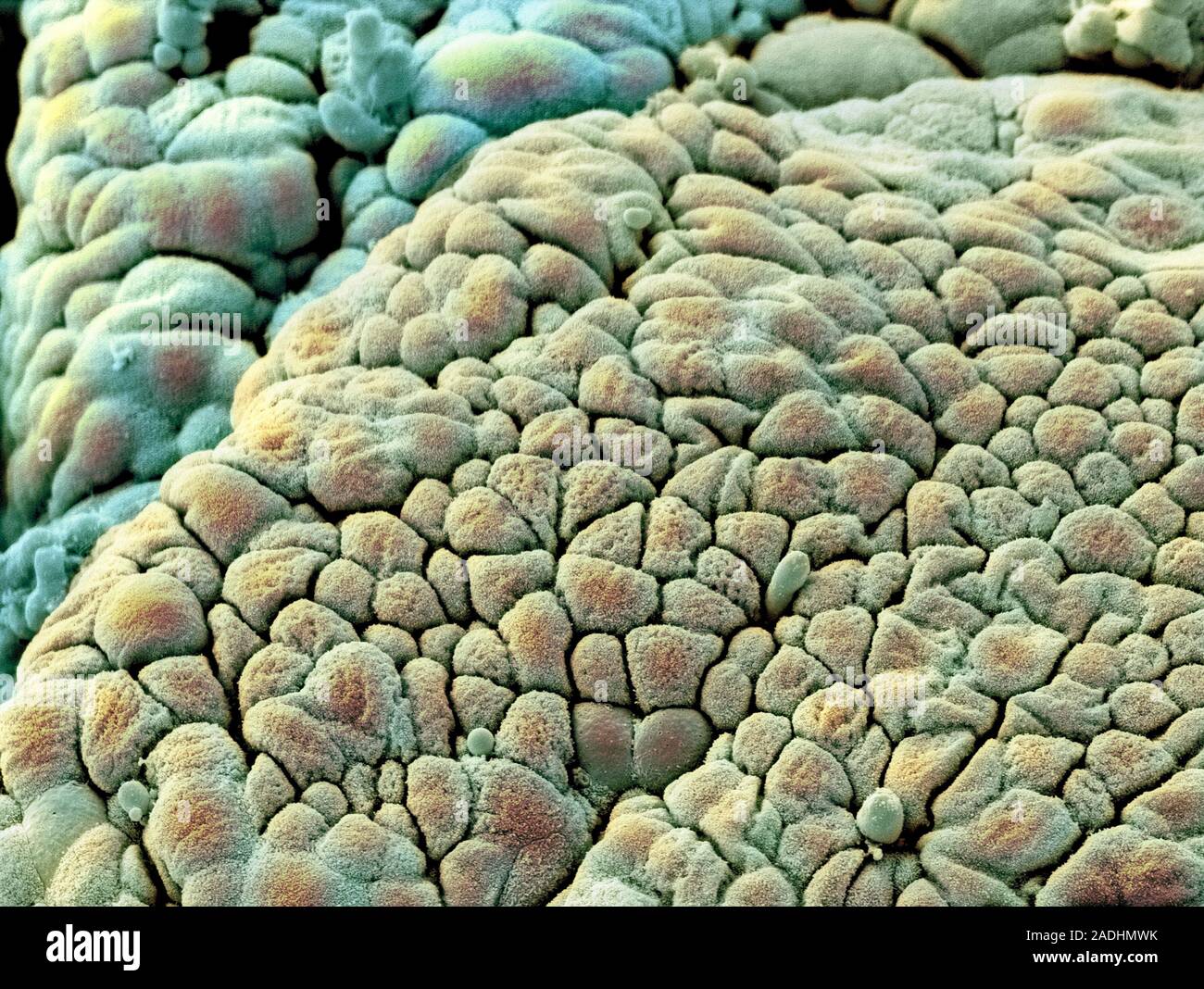 Rectal polyp. Coloured scanning electron micrograph (SEM) of the ...