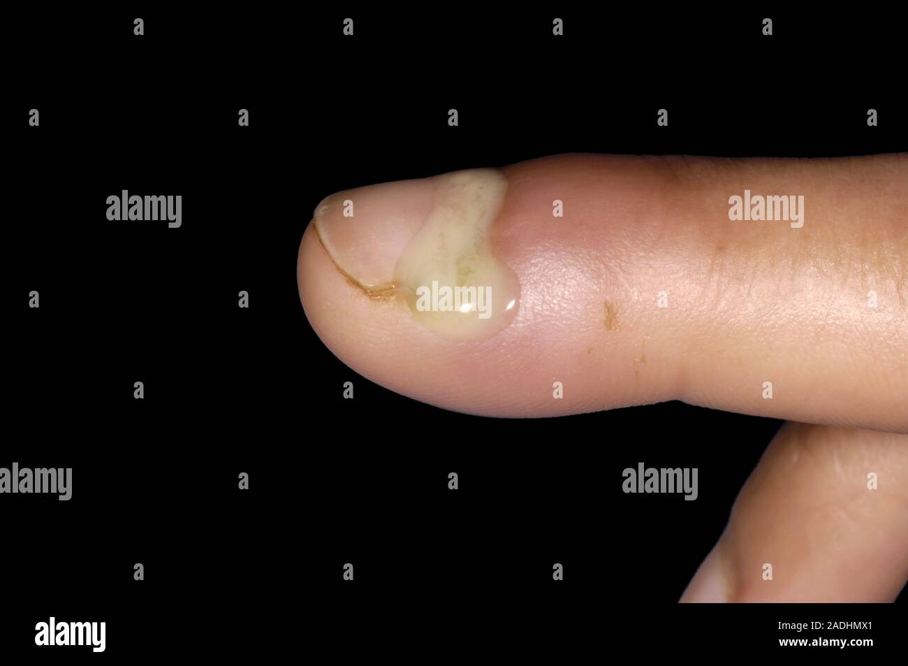 Paronychia on a finger of a 29 year old woman following drainage ...