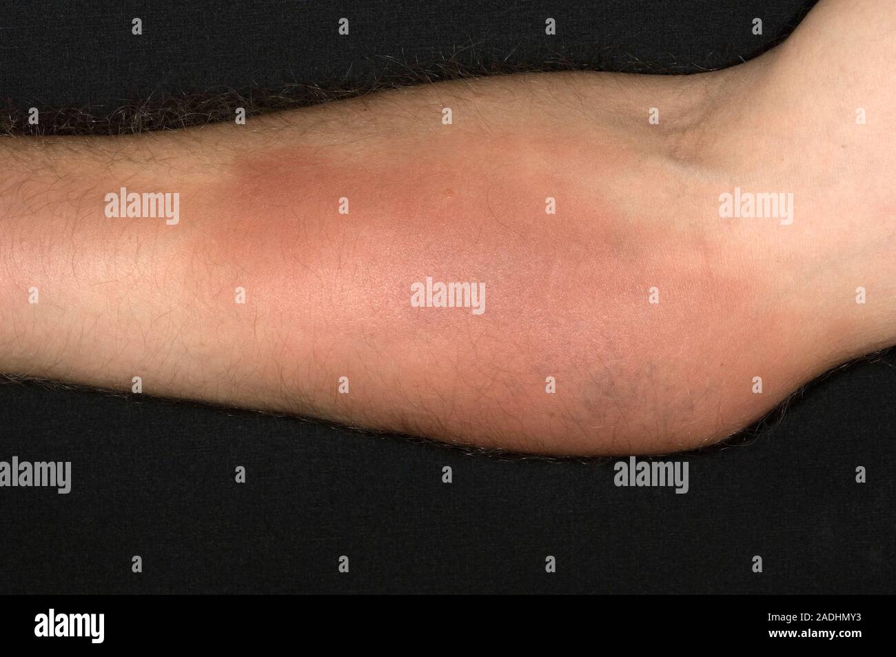 Superficial phlebitis in a 52 year old man's lower arm. Phlebitis is an ...