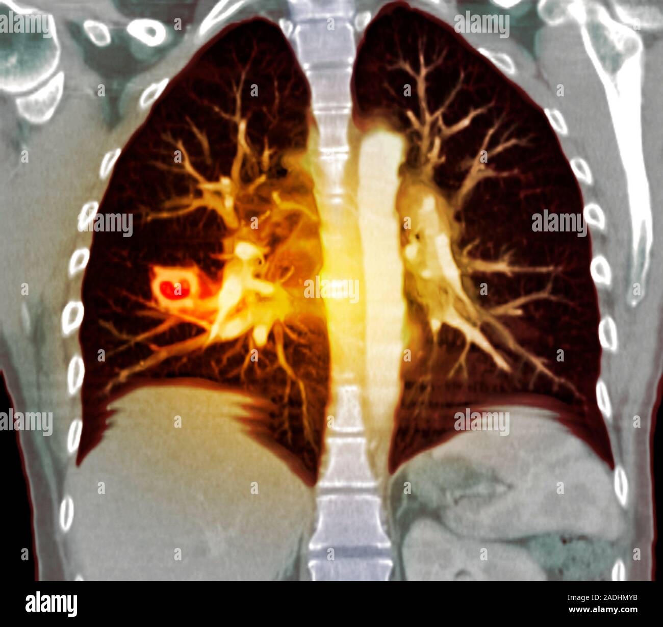 Lung lesion. Coloured frontal computed tomography (CT) scan of a woman ... Lung lesion. Coloured frontal computed tomography (CT) scan of a woman ...