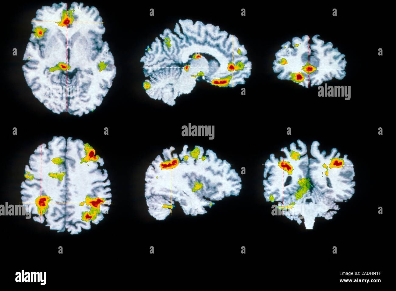 Obsessive-compulsive disorder. Coloured Positron Emission Tomography ...