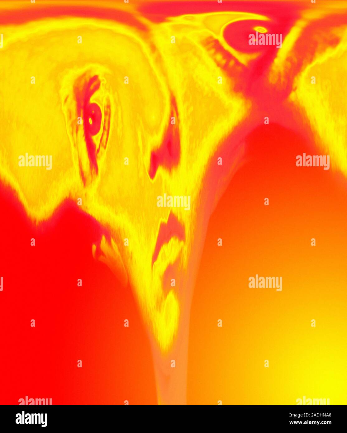 Mental disorder. Conceptual image of the contorted face of a person ...