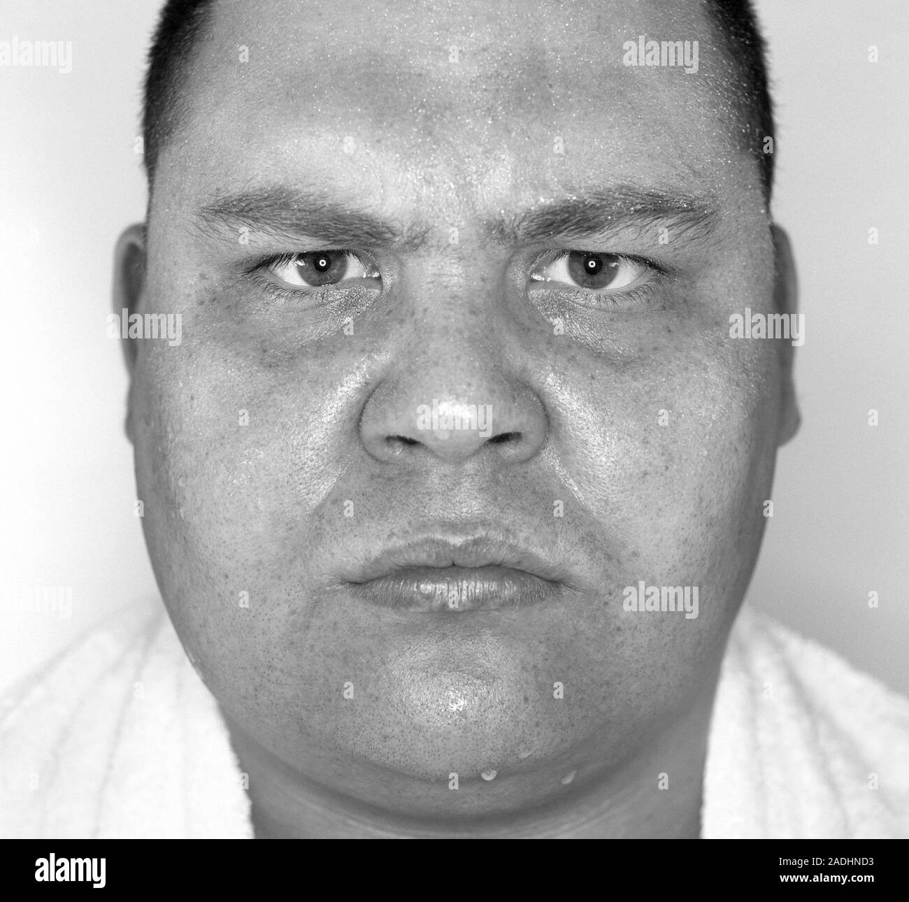 Anger. Sweaty face of an overweight man Stock Photo - Alamy