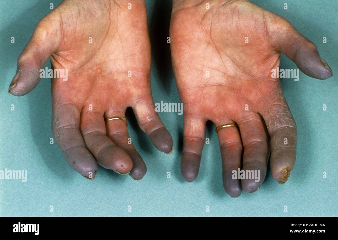 Photograph of the hands of a person suffering from Raynaud's disease, a ...