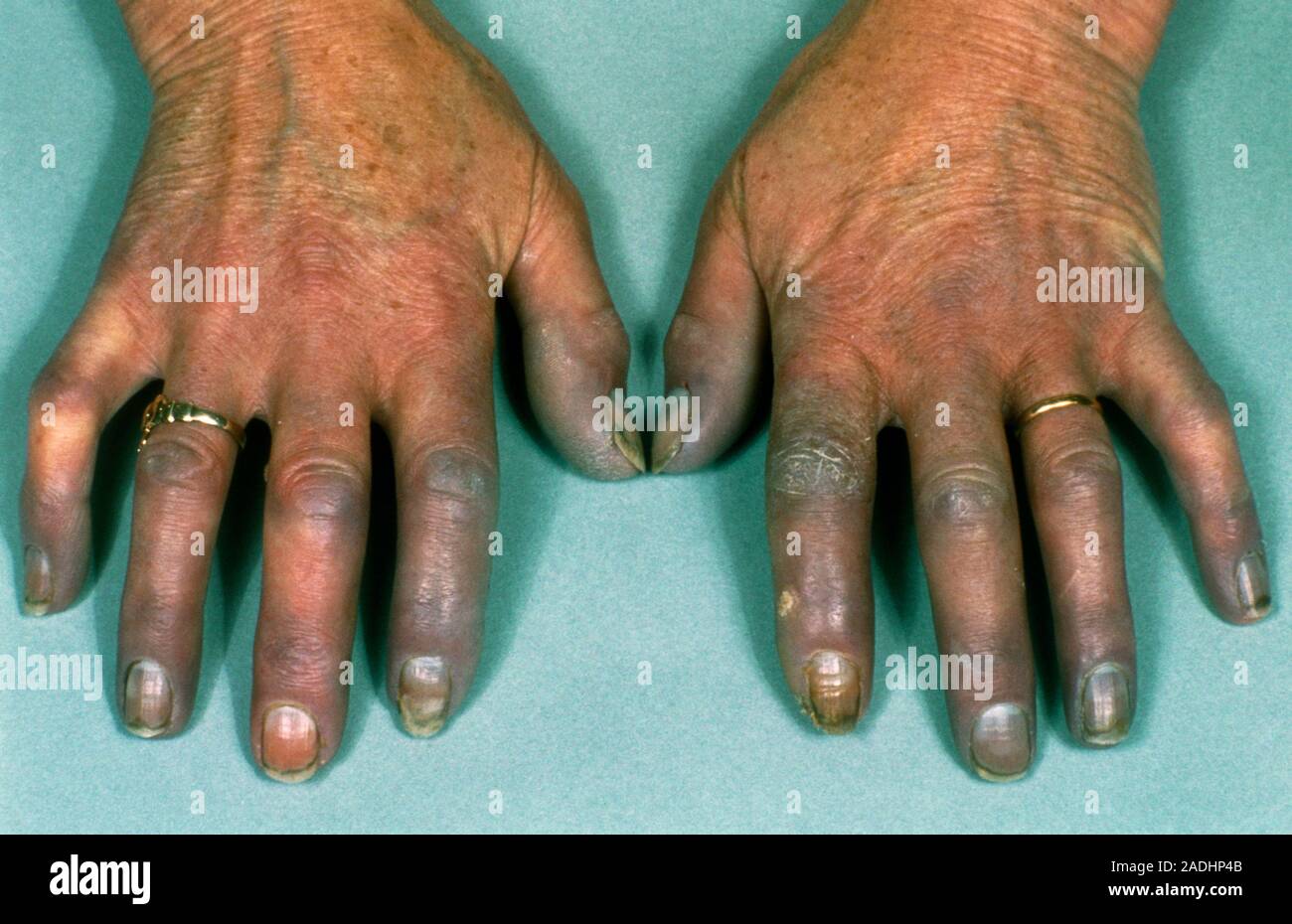 Photograph of the hands of a person suffering from Raynaud's disease, a ...