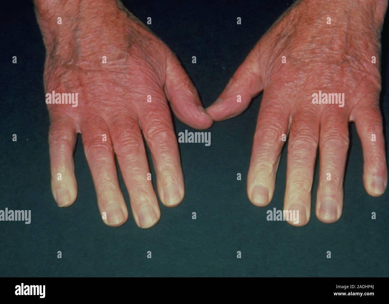 Vasospasm. The hands of an elderly man whose fingertips have whitened ...