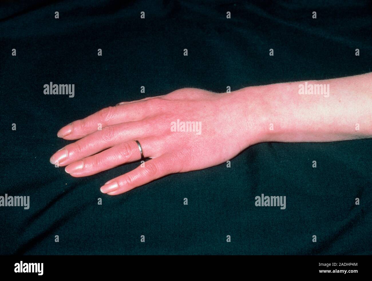Raynaud's phenomenon. The hand of a young woman whose fingers have ...